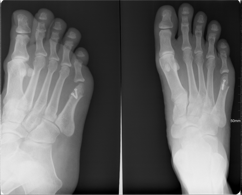 Hammertoe Correction Surgery in NYC | Downtown Podiatry Physicians