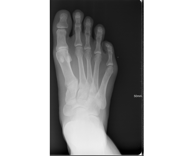 Hammertoe Correction Surgery in NYC | Downtown Podiatry Physicians